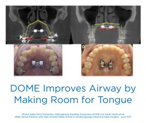 DOME for Sleep Apnea Improves Airway Making Room for Tongue - Airway ...